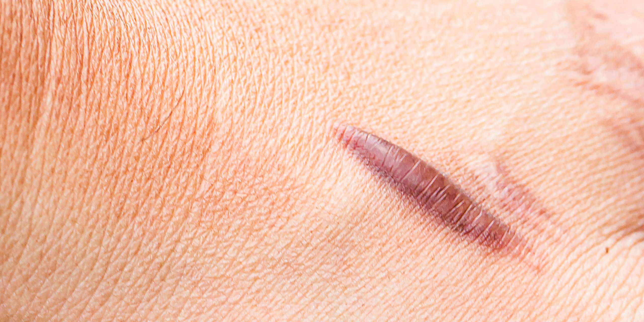 Best Keloid Specialist in Vienna, VA - Dr Yousefi