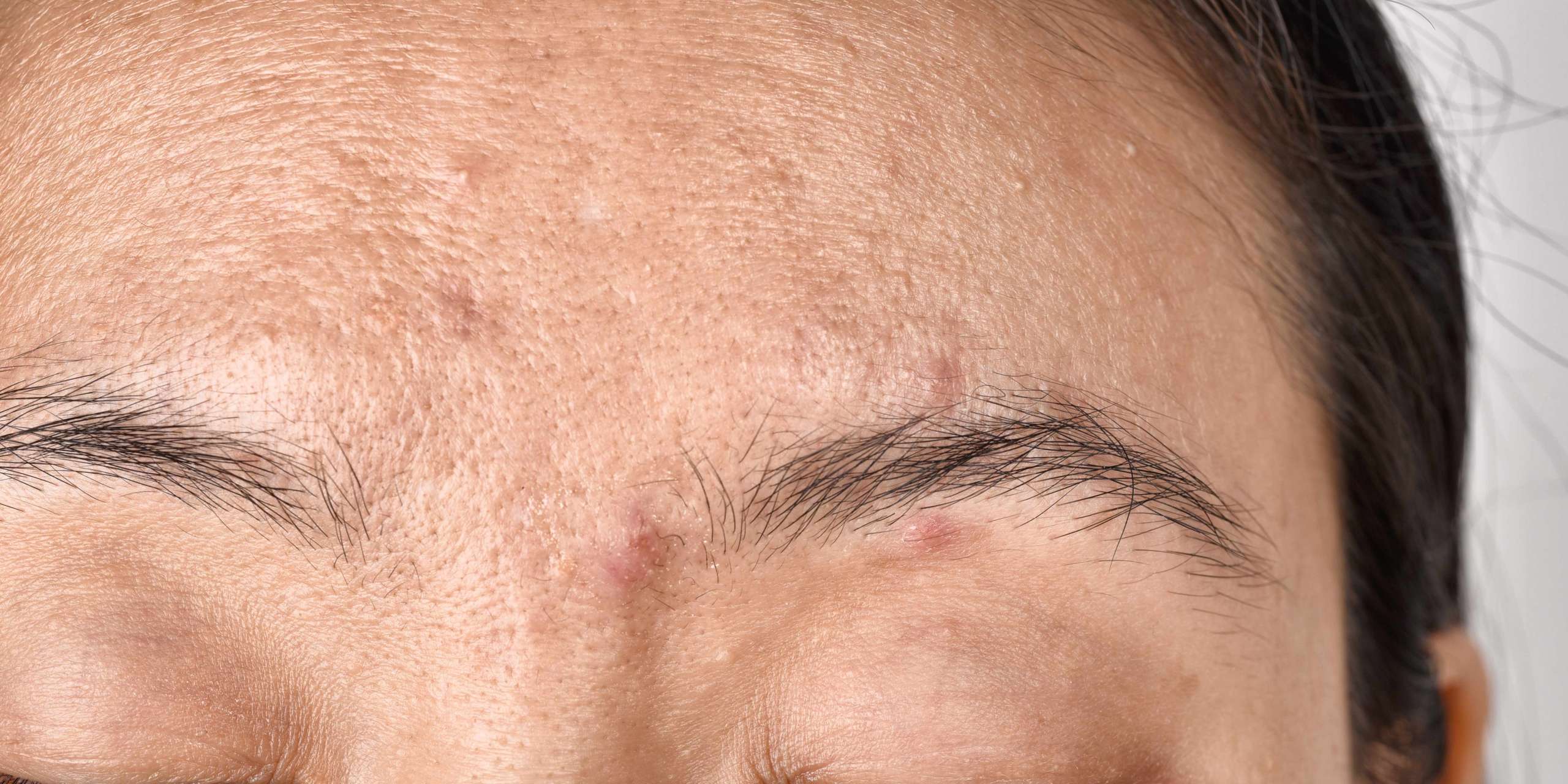 Best Acne Scar Treatment in Arlington, Virginia - Dr Yousefi