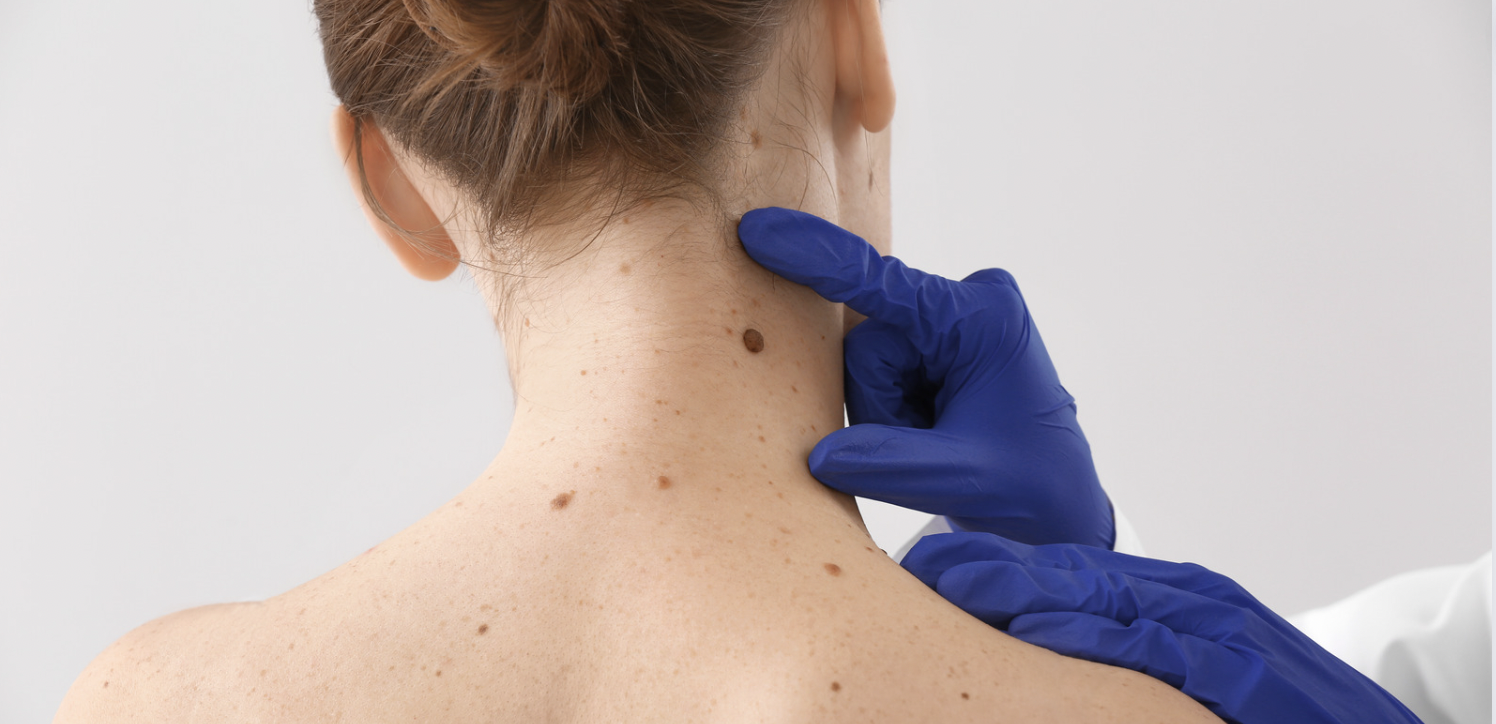 How to Find a Skin Cancer Doctor in Vienna, VA - Dr Yousefi