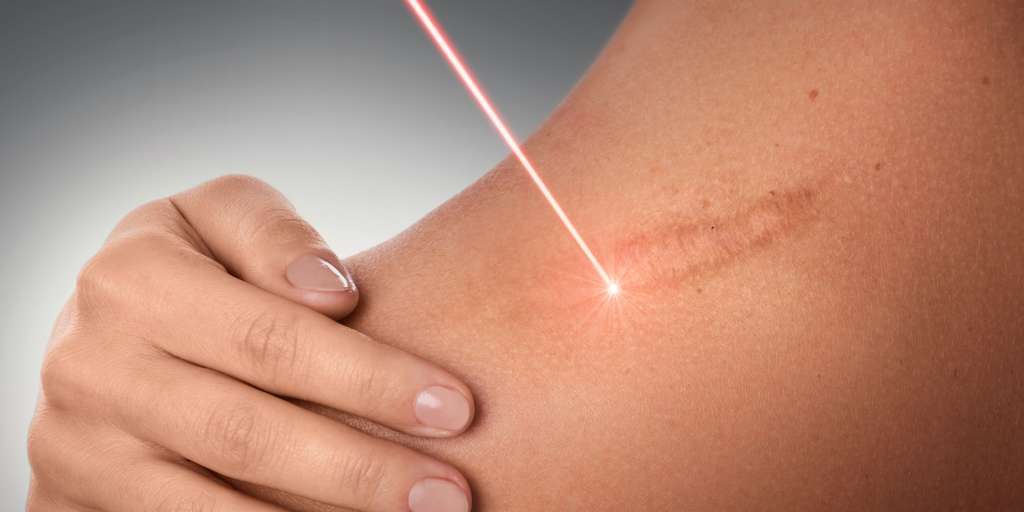 Scar Removal - Dr Yousefi