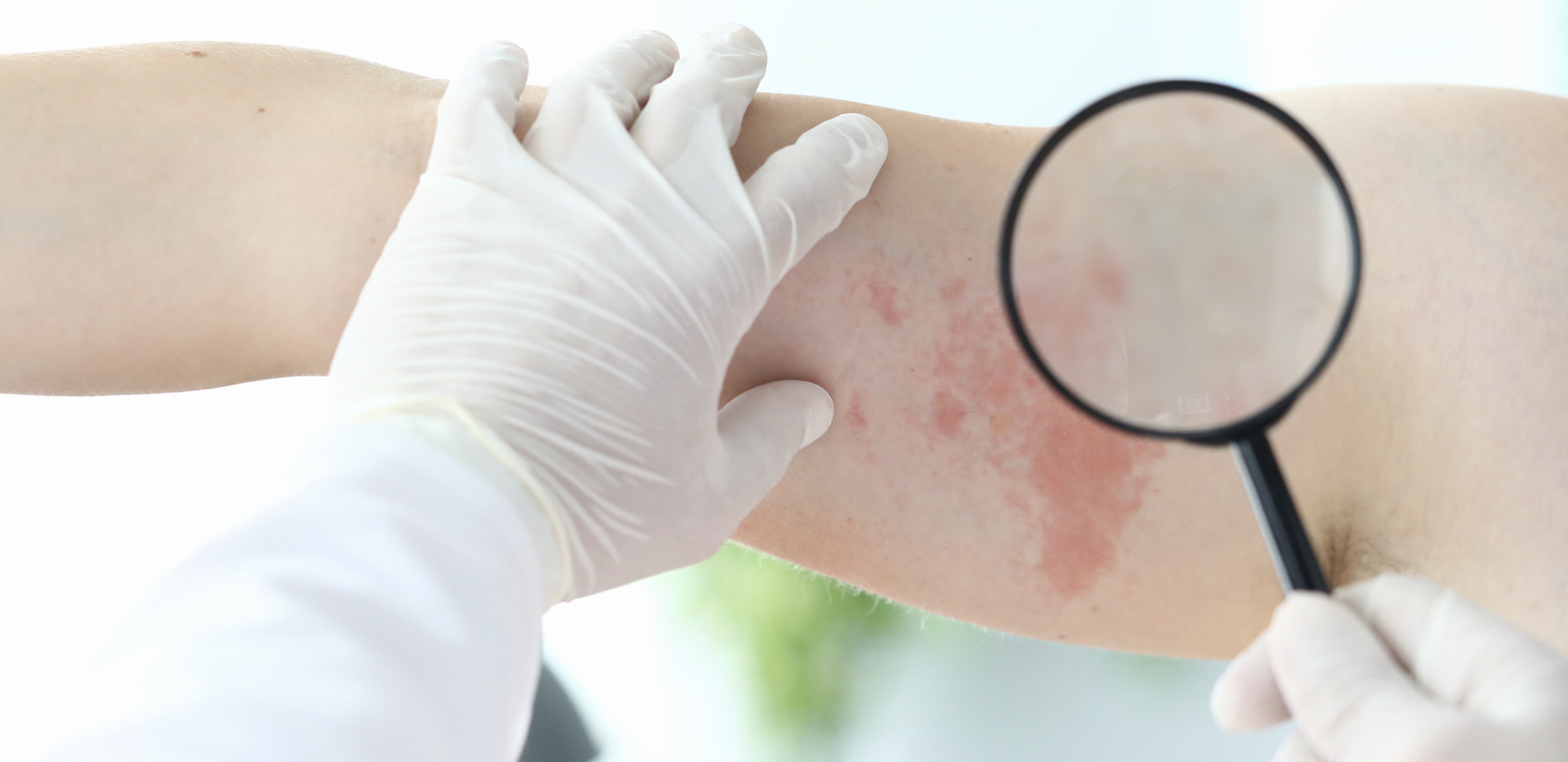 Same-Day Emergency Rash Appointment in Annandale - Dr Yousefi