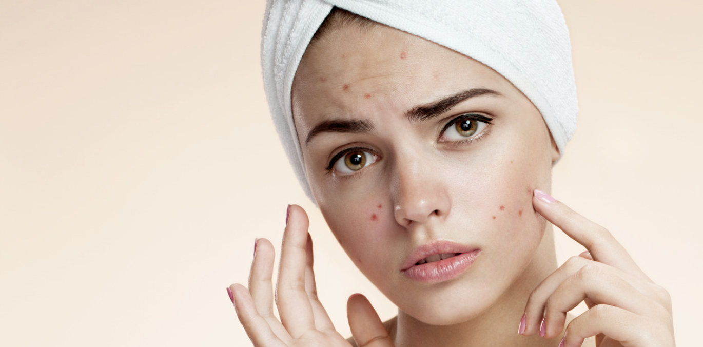 Top Dermatology Treatments for Acne Near Vienna and Falls Church - Dr ...