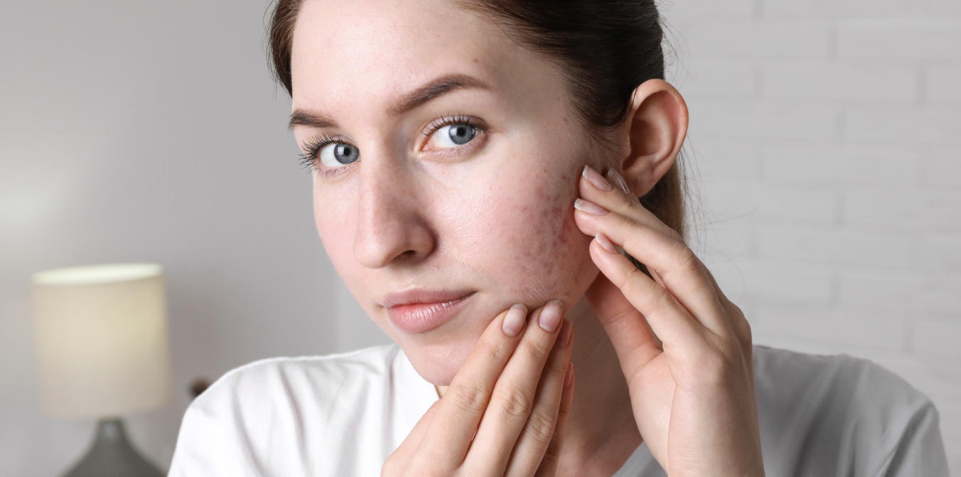 Fast and Effective Acne Treatments for Same-Day Relief - Dr Yousefi
