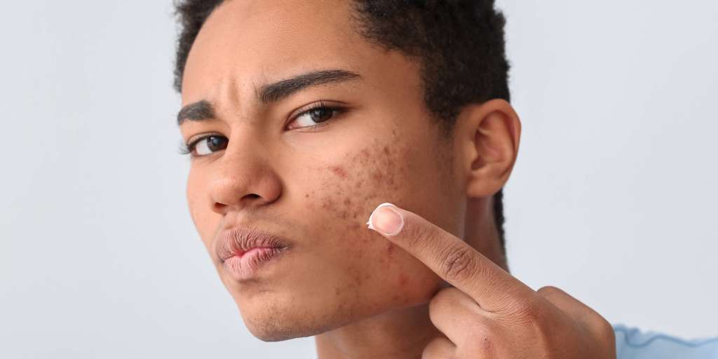 Book a Dermatology Appointment for Sudden Acne Breakouts Near McLean ...