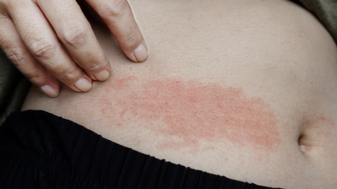 Dermatology Evaluation for Chronic Hives and Skin Allergies Near McLean ...