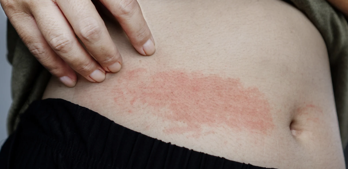 Dermatology Evaluation for Chronic Hives and Skin Allergies Near McLean ...