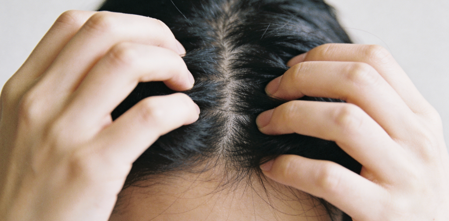 Hair Loss and Scalp Irritation Dermatology Appointment Near McLean, VA ...