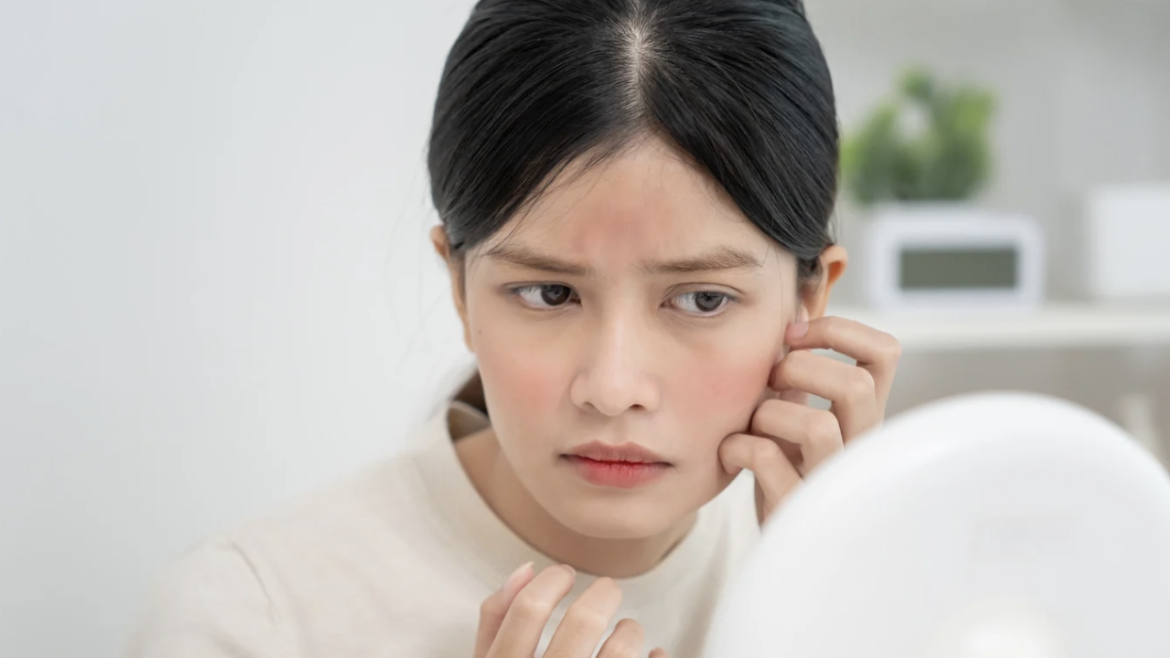 Rosacea Diagnosis and Redness Treatment Options Near McLean, VA - Dr ...