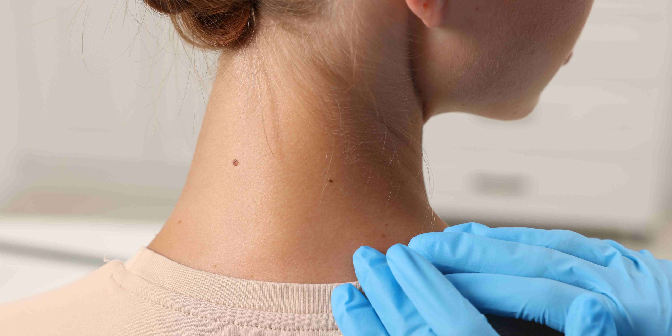 Dermatology Appointment for a Mole Check in Vienna, Virginia - Dr Yousefi